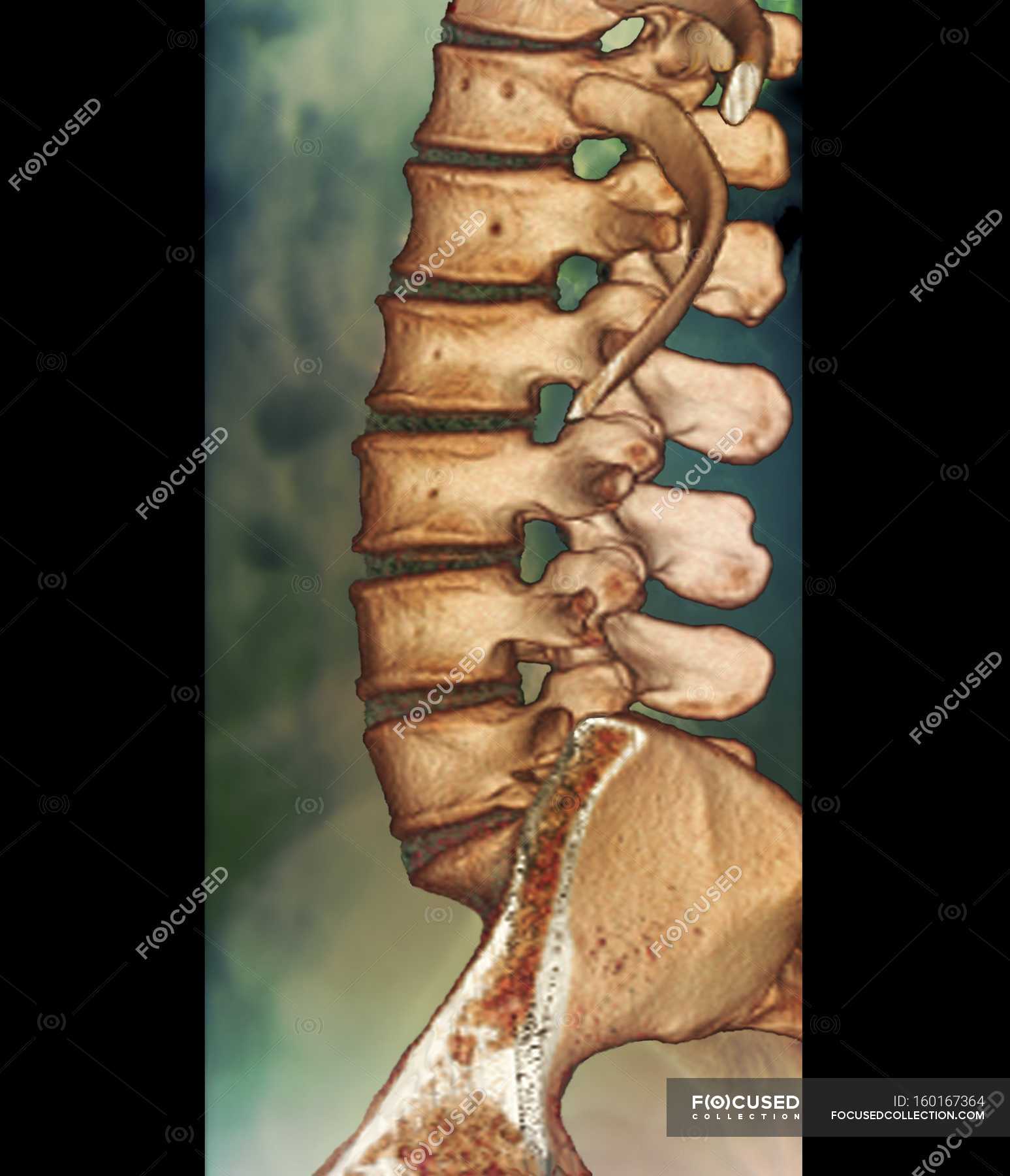 Colored computed tomography scan of lumbar spine. — healthcare ... Colored computed tomography scan of lumbar spine. — healthcare ...