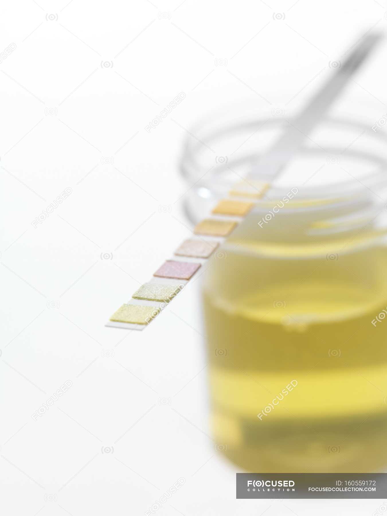 Urine Sample With Test Strip Showing Results Diabetic Container urine-sample-with-test-strip-showing-results-diabetic-container