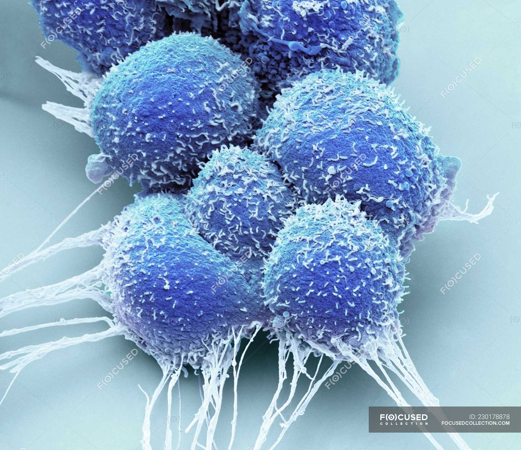 Prostate cancer cells, coloured scanning electron micrograph ... Prostate cancer cells, coloured scanning electron micrograph ...