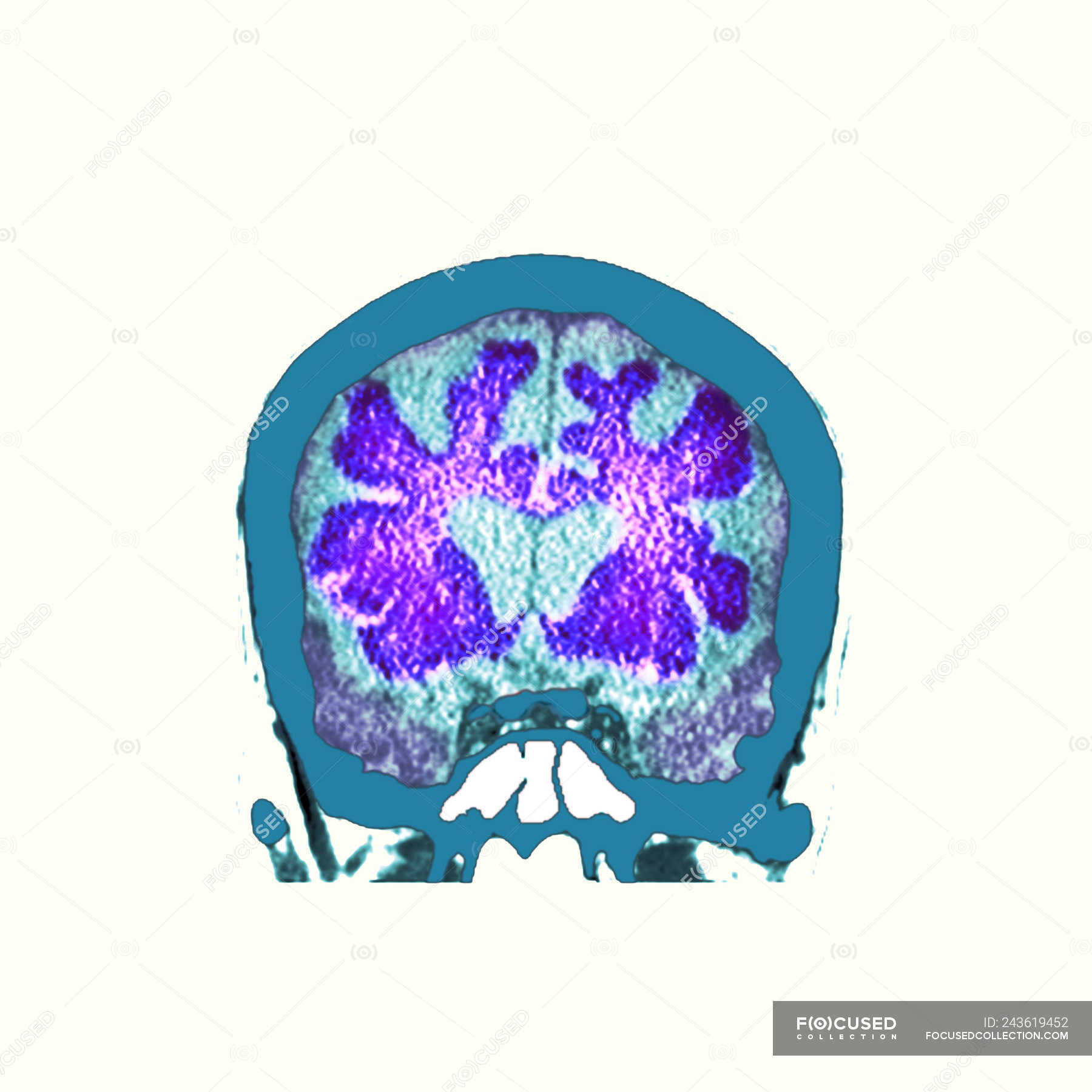 Colored computed tomography scan of section through brain of senior ... Colored computed tomography scan of section through brain of senior ...