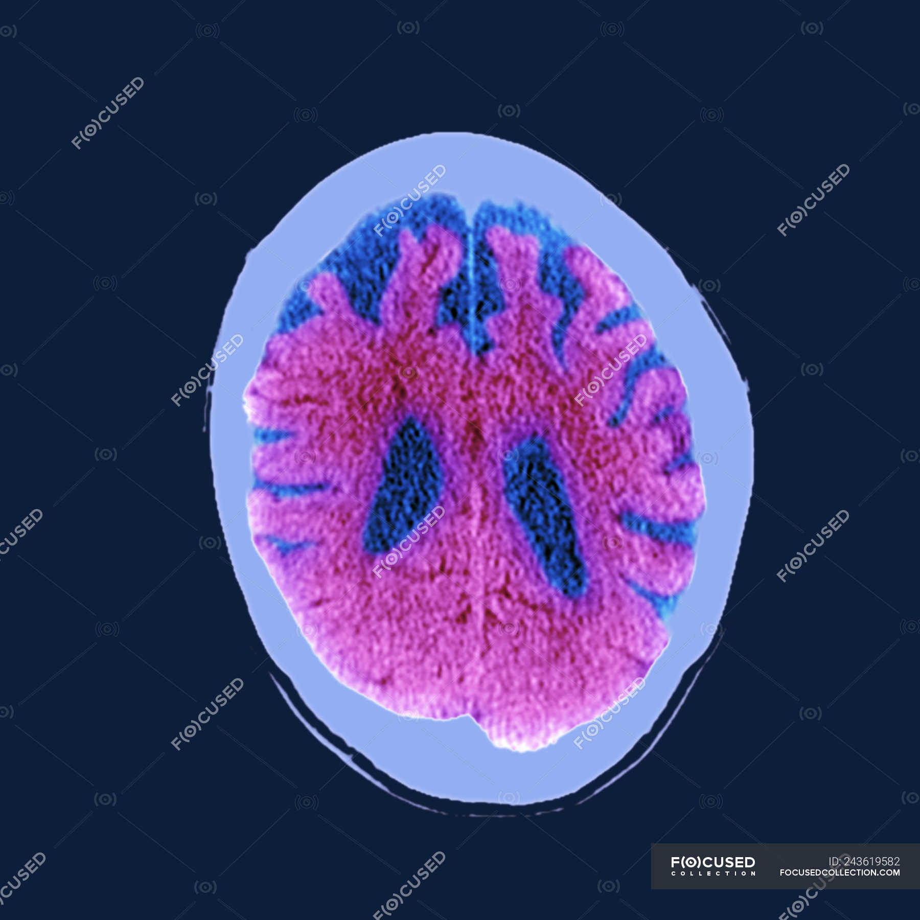 Colored computed tomography scan of section through brain of senior ... Colored computed tomography scan of section through brain of senior ...
