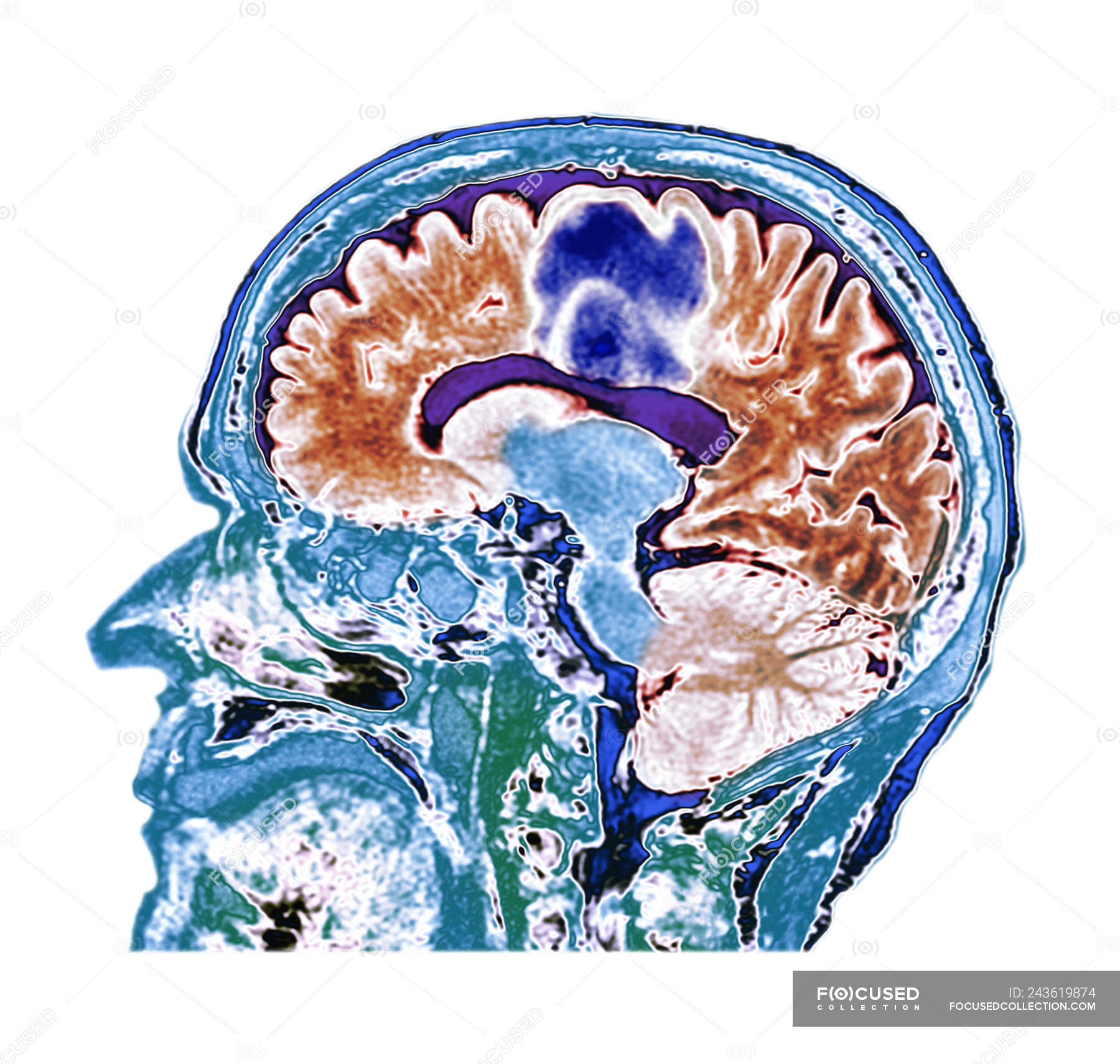 Farbige Computertomographie des Gehirnschnitts einer älteren Patientin ... Farbige Computertomographie des Gehirnschnitts einer älteren Patientin ...