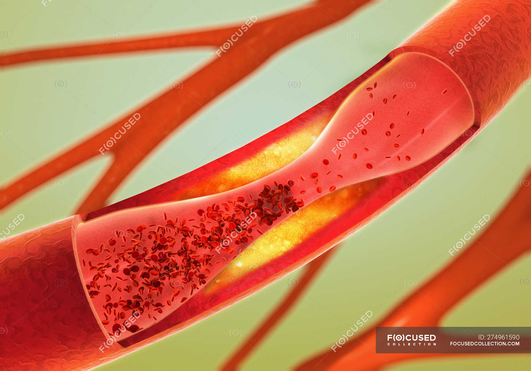 3d digital illustration of narrowed blood vessel. — red blood cells ... 3d digital illustration of narrowed blood vessel. — red blood cells ...