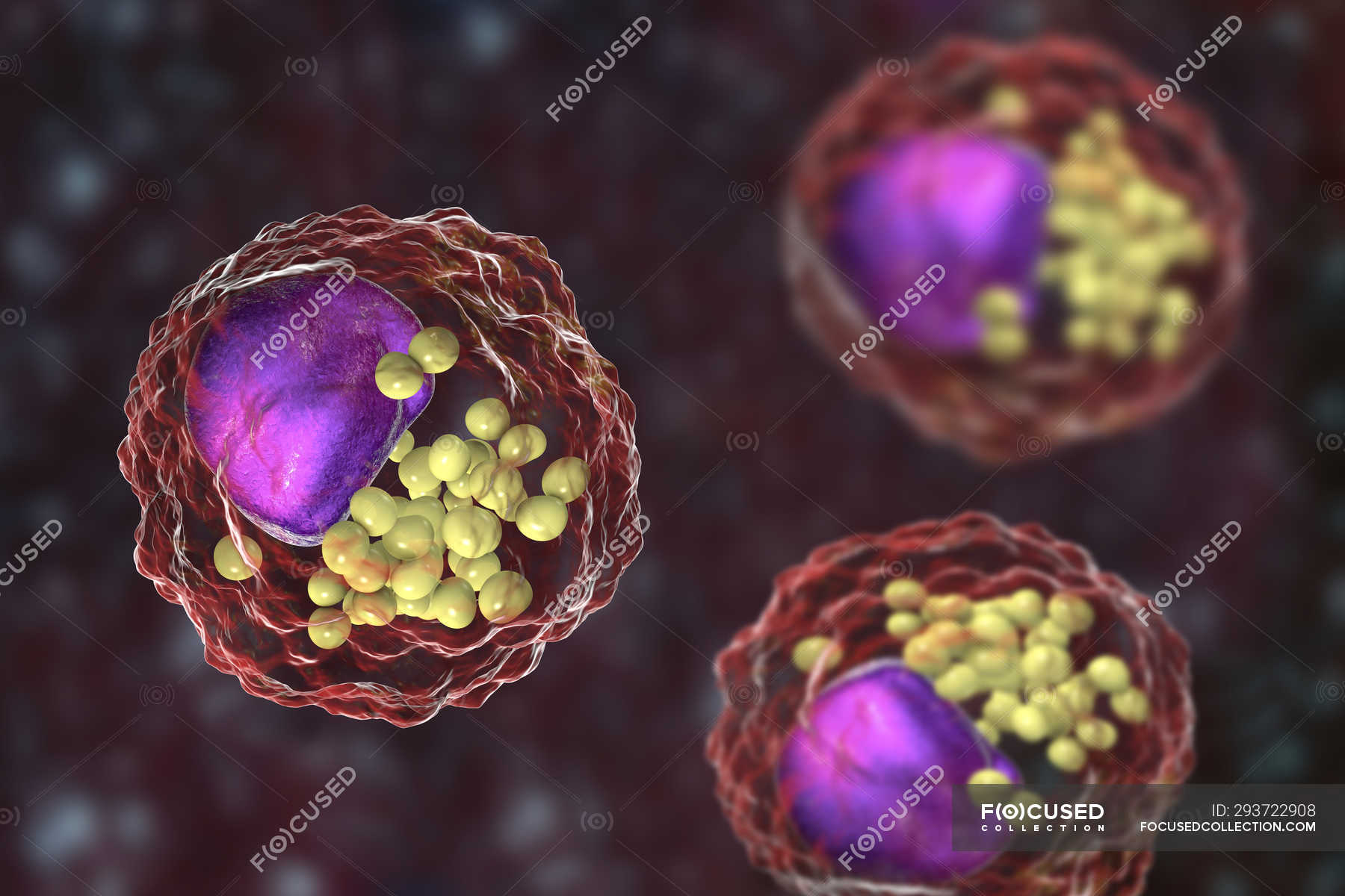 Macrophage Foam Cells Containing Lipid Droplets Digital Illustration — Macrophages Digitally