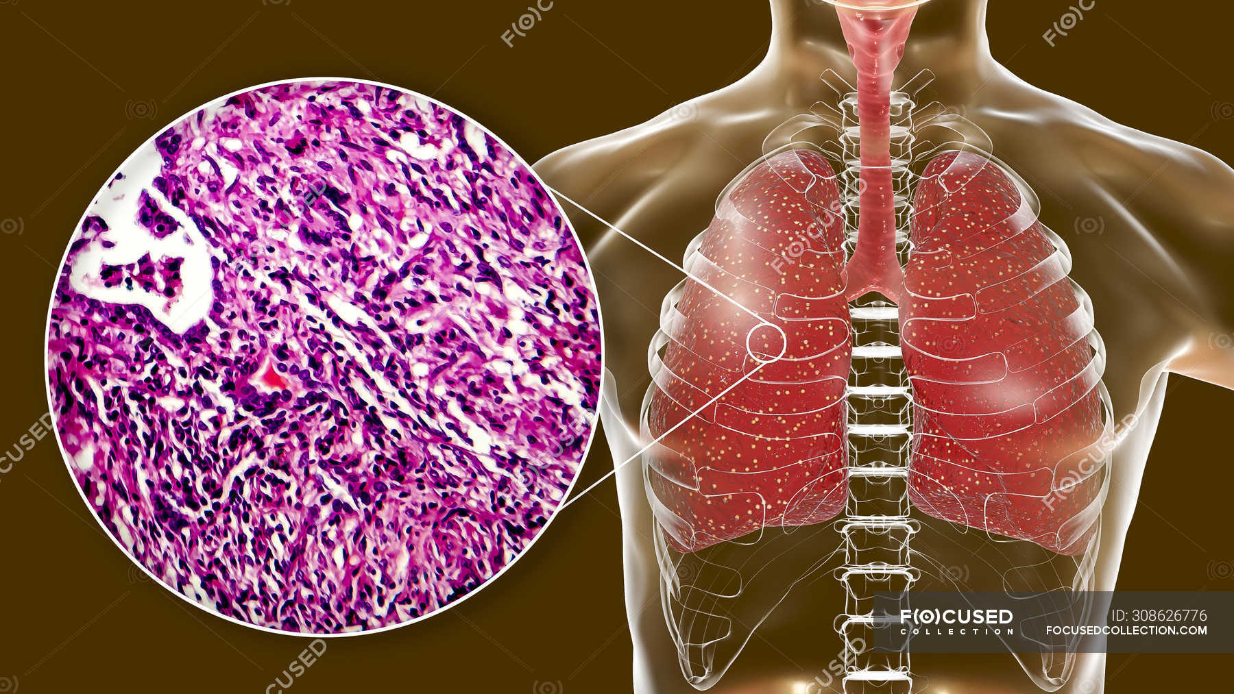 Miliary Tuberculosis Disease In Lungs Digital Illustration And Light